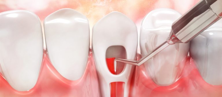 Why Root Canal Treatment Is Better?